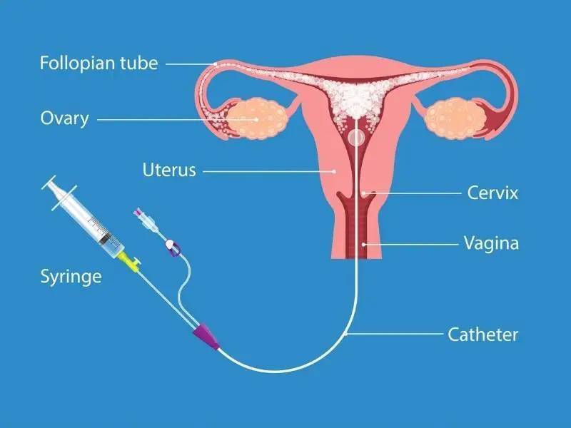 Your Fertility Journey Starts with the HSG (Tube test) in Delhi