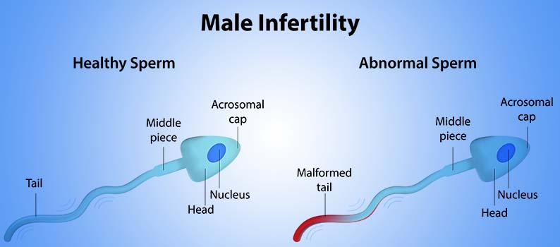 Male Infertility – Causes, Diagnosis & Treatment | God’s Grace IVF